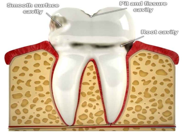 Unraveling the Enigma: A Journey Through the History of Cavities
